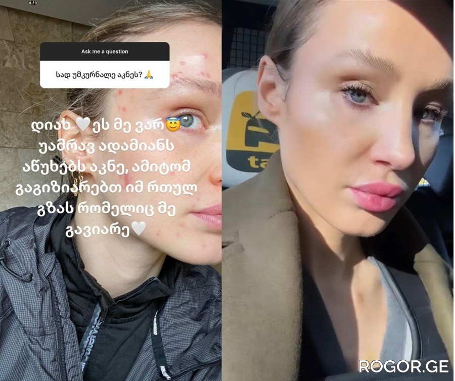 როგორ უმკურნალოთ აკნეს - ანუკი არეშიძის რჩევები - rogor.ge